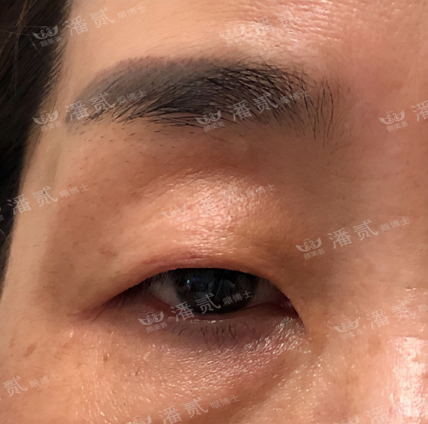 Can the drooping tail of the eye be changed by double eyelid surgery ...