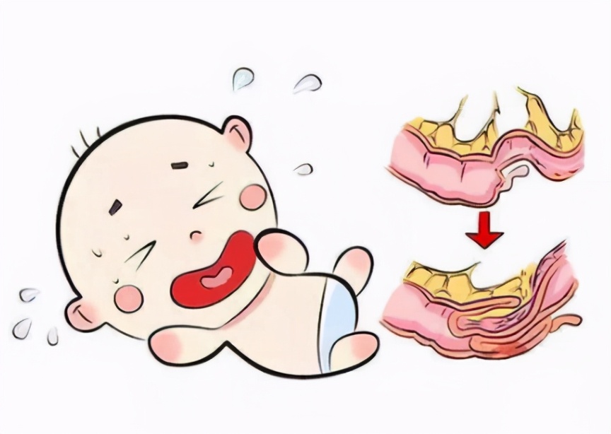 Intussusception can be life-threatening, and it is more common in ...