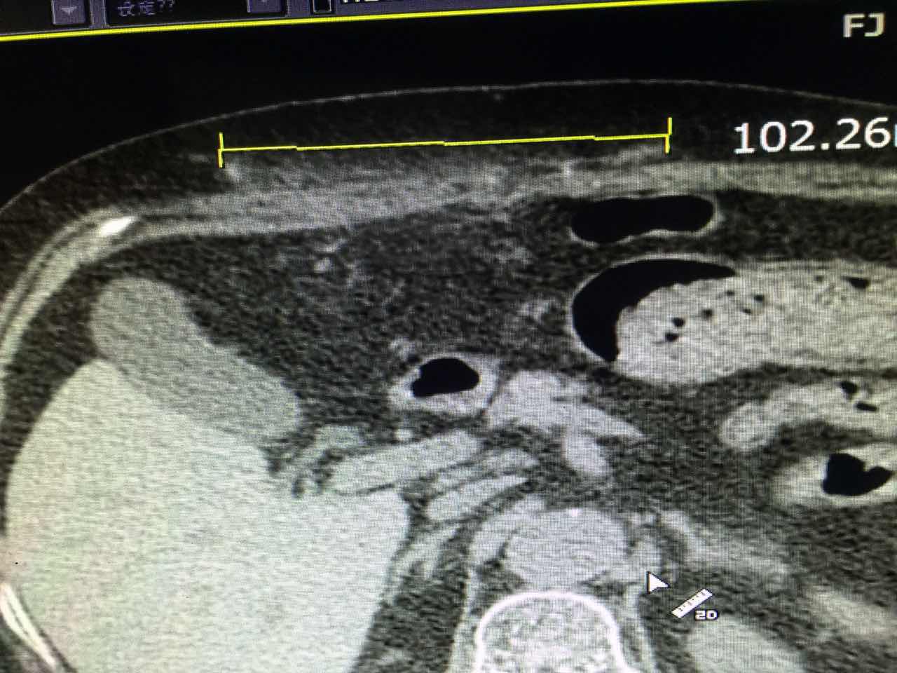 White line hernia has no obvious symptoms and can be easily ...