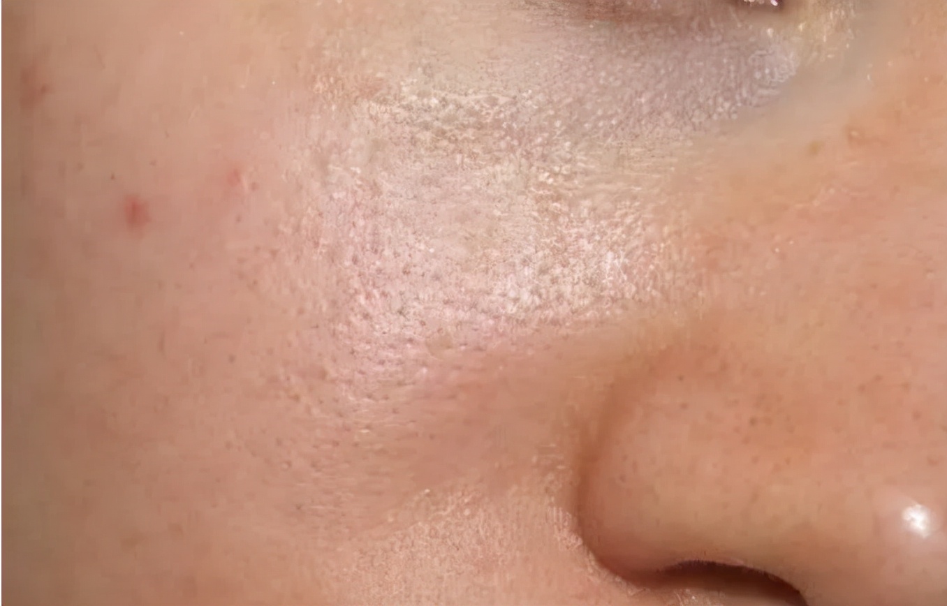 What to do with "large pores"?Master these techniques to effectively ...