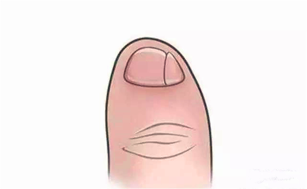 What is the origin of people who split their little toenails in two?Are ...