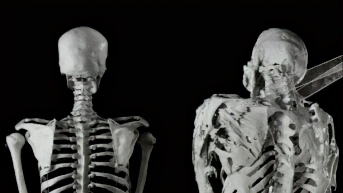 People who are "killed" by their own bones, human organs are alienated ...