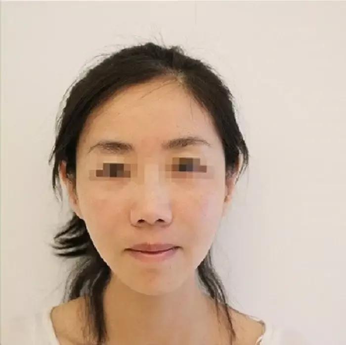 "42-year-old Ms. Yan" 30 days after the PSV facial lift, the whole ...