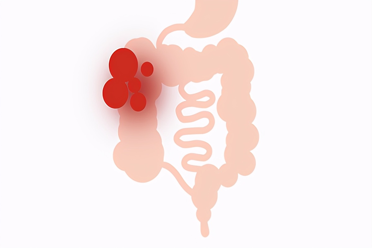 Bleeding in the stool is hemorrhoid or intestinal cancer? The doctor ...