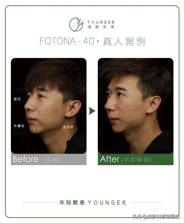 The fotona-4D Pro, which has been popular in the entertainment industry ...