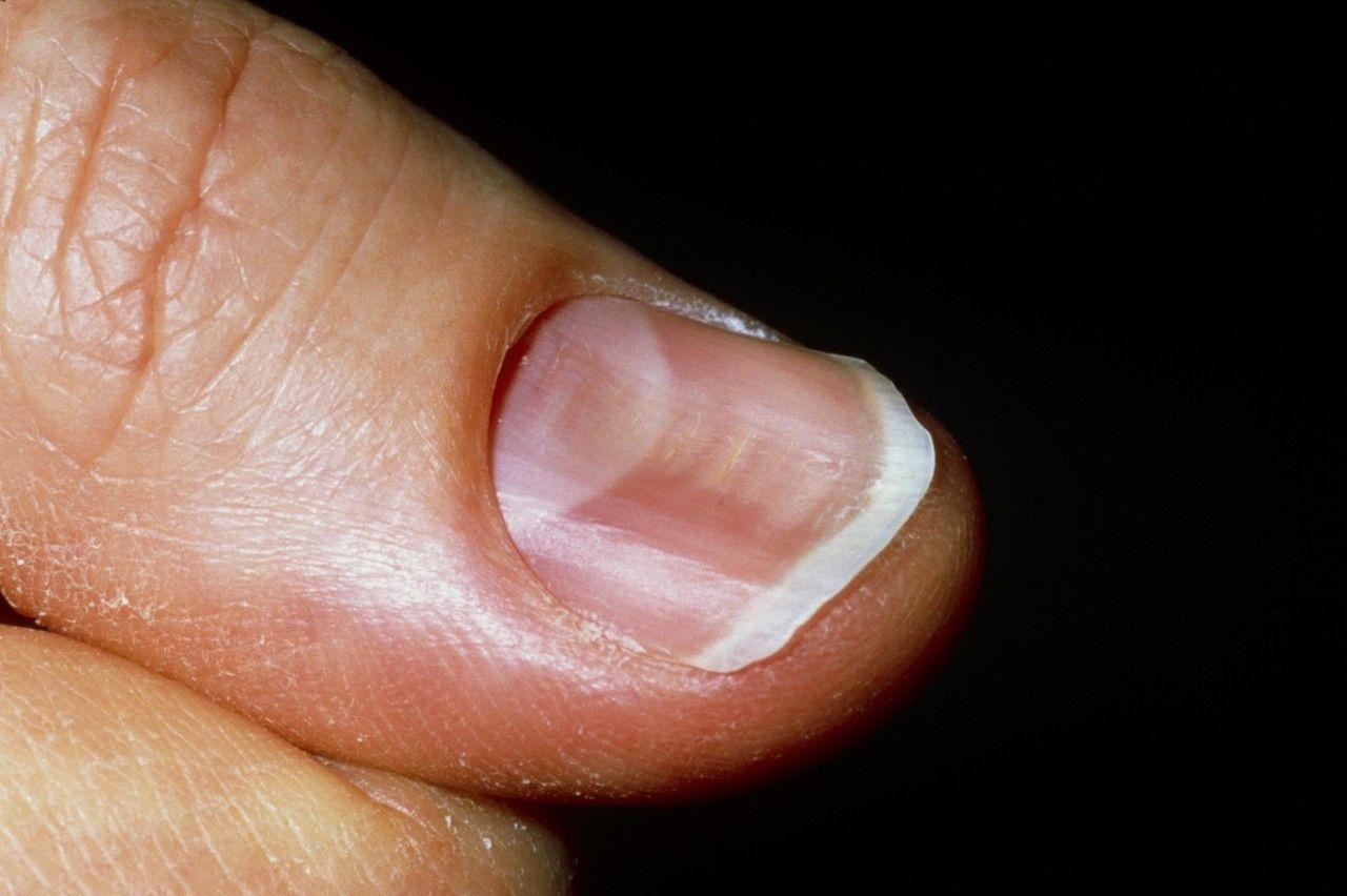 Ten fingernails and no crescent, mean that the body is unhealthy? This ...