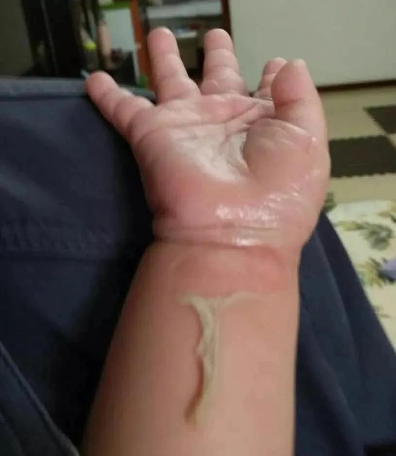What should I do if my baby burns? Are you still using these remedies ...