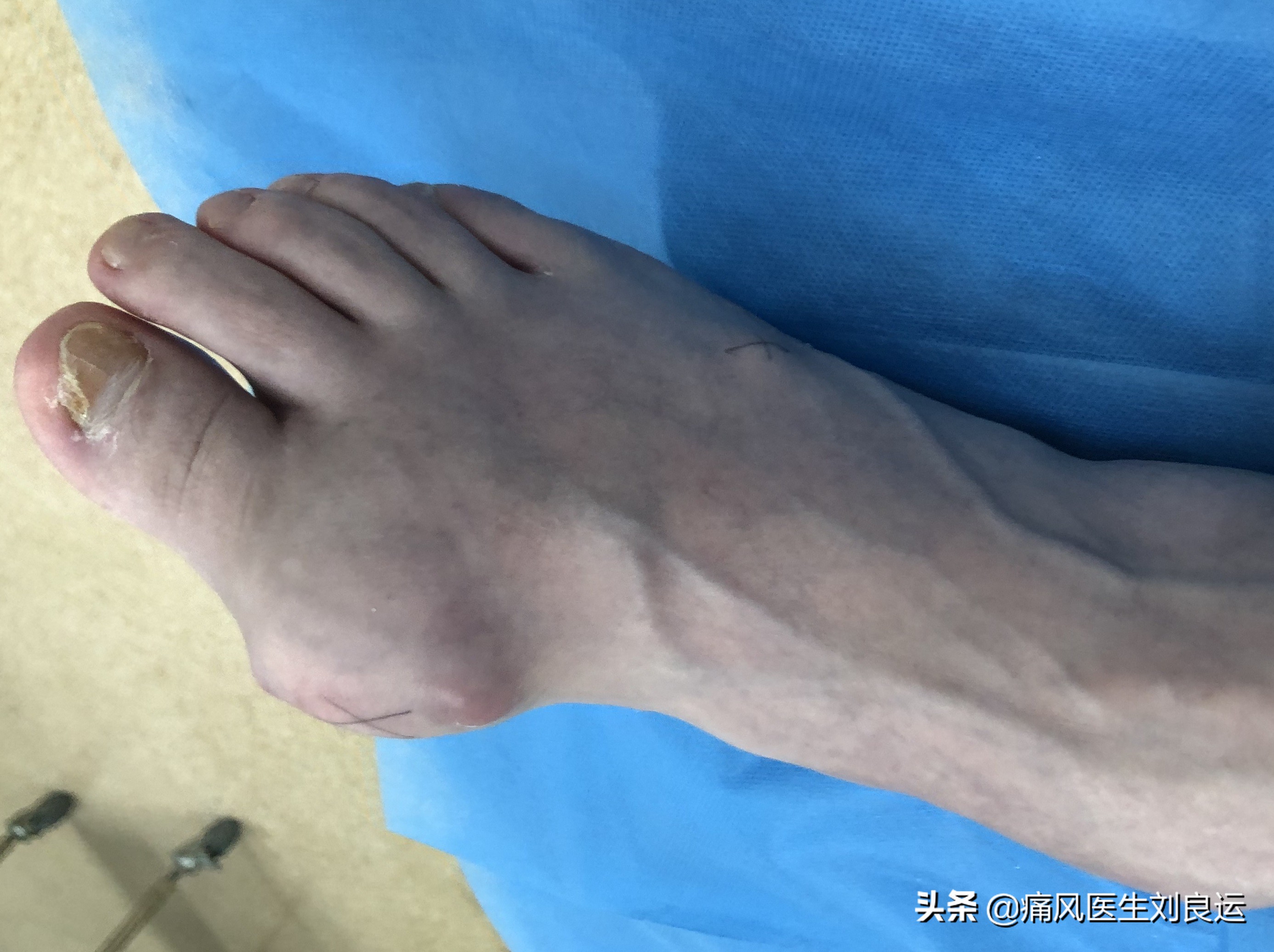 There is no need for surgery after tophi, because if it is cut, it will ...