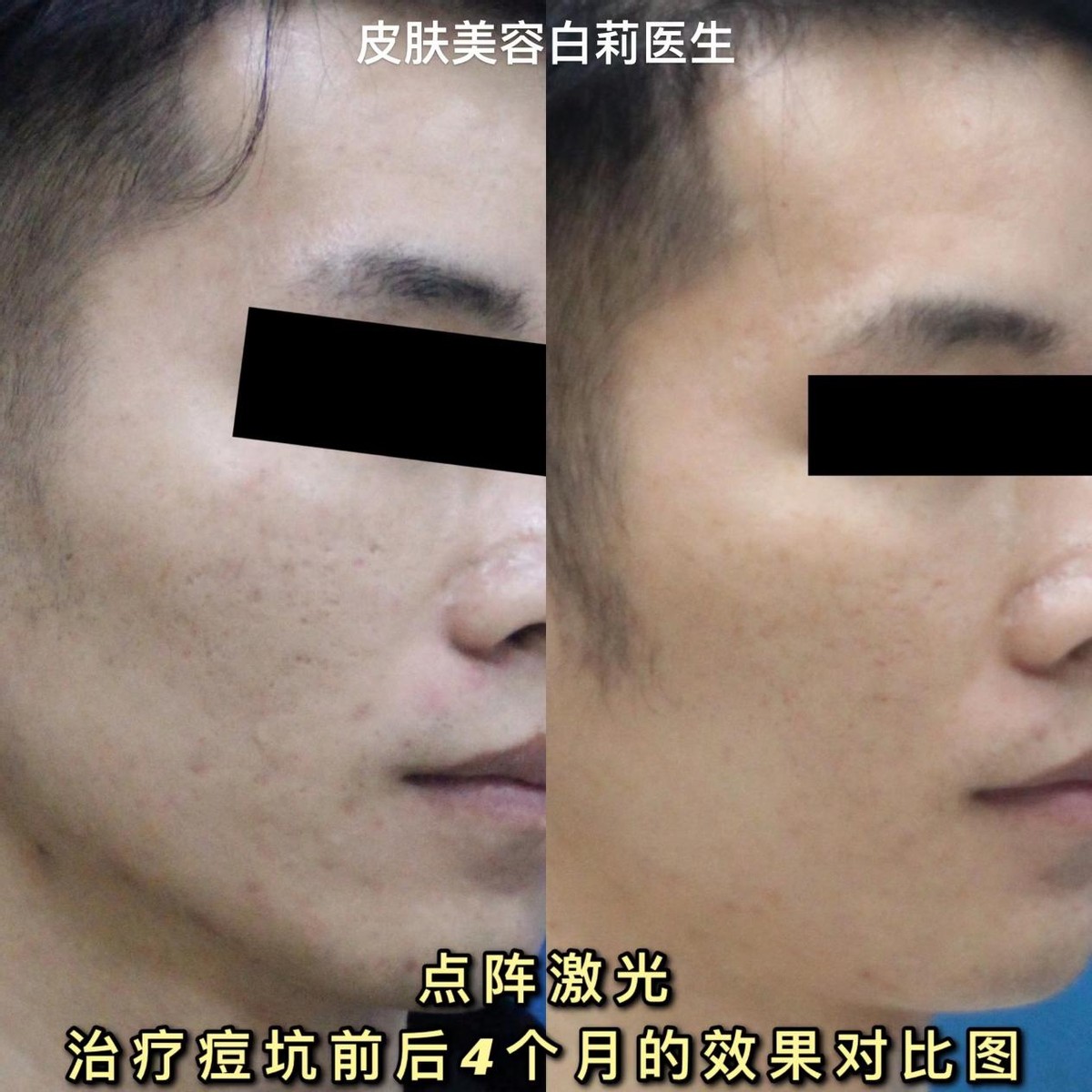 Is your face covered with acne pits and acne marks, so troublesome?Don ...