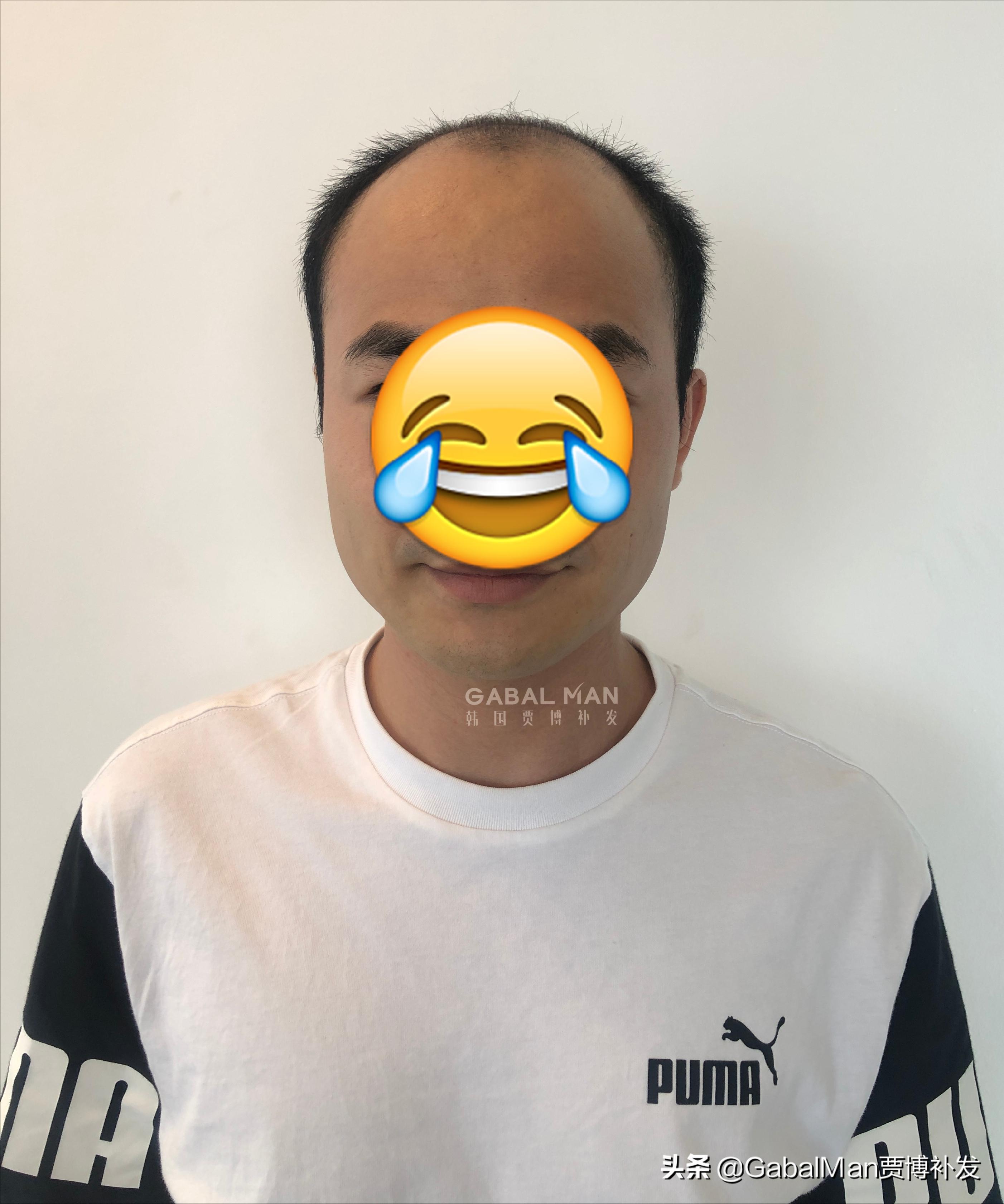 21-year-old is called "Uncle Bald", mastering this method will make you ...