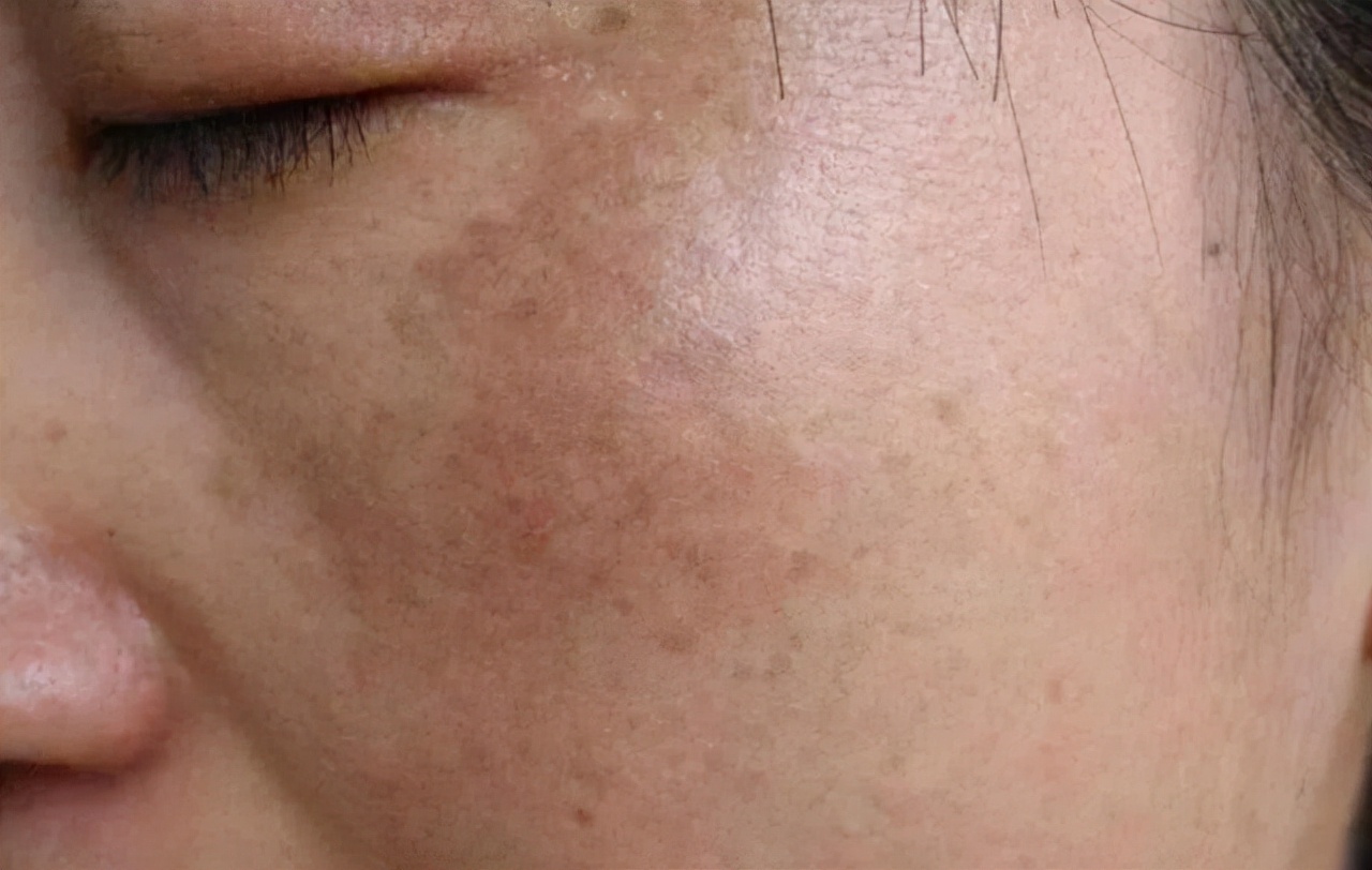 Why are middle-aged women prone to chloasma on their faces?After the ...