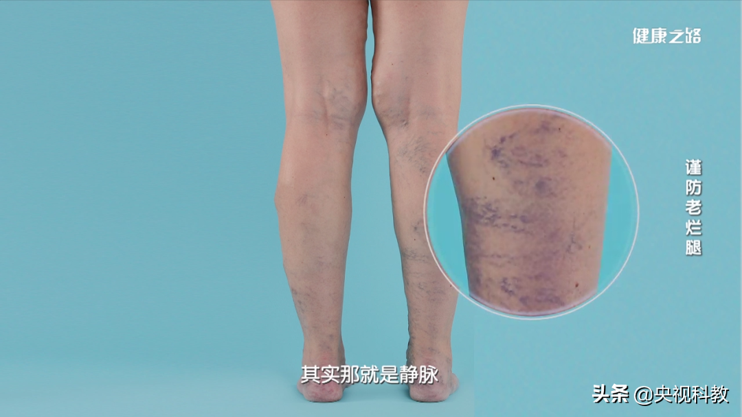 Pay attention to varicose veins! Otherwise the "old rotten legs" will ...