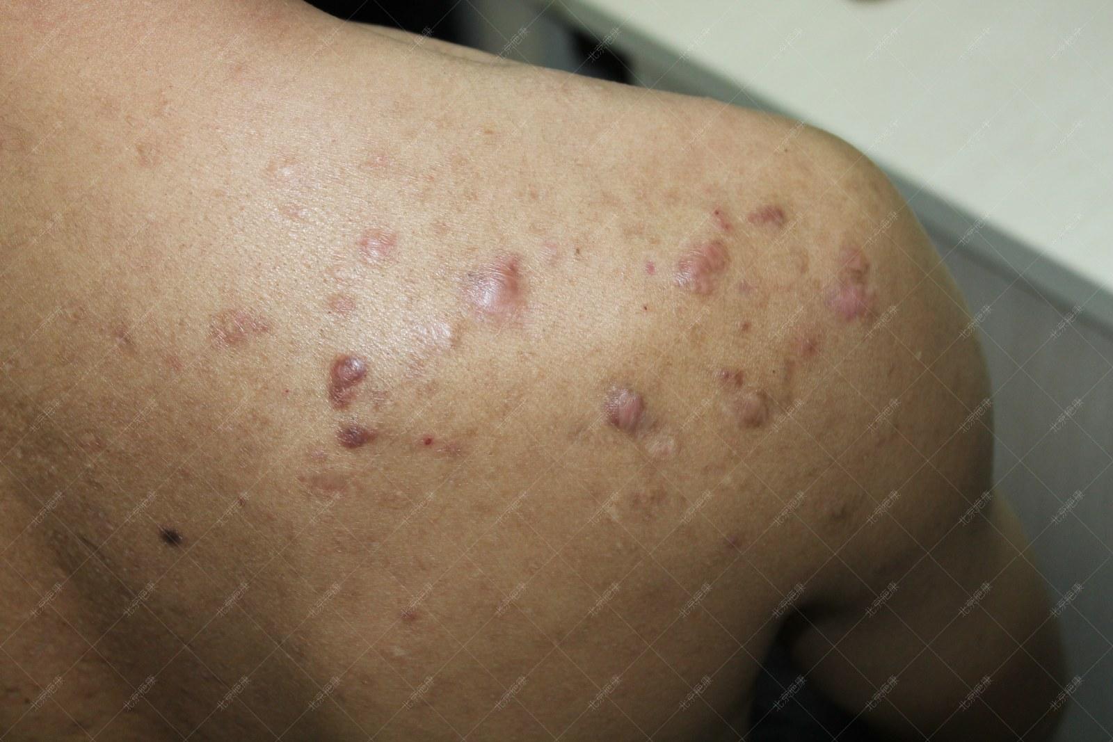 (Scar Kang) Red and swollen bumps on the shoulders - iNEWS