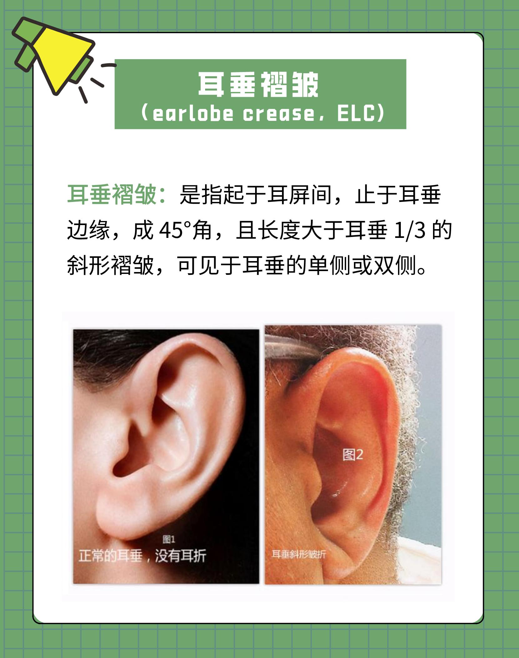 This crease on the ear is a signal of coronary heart disease or ...