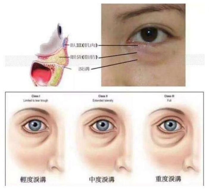 How to improve the tear ditch hidden in the face?The doctor shared 3 ...