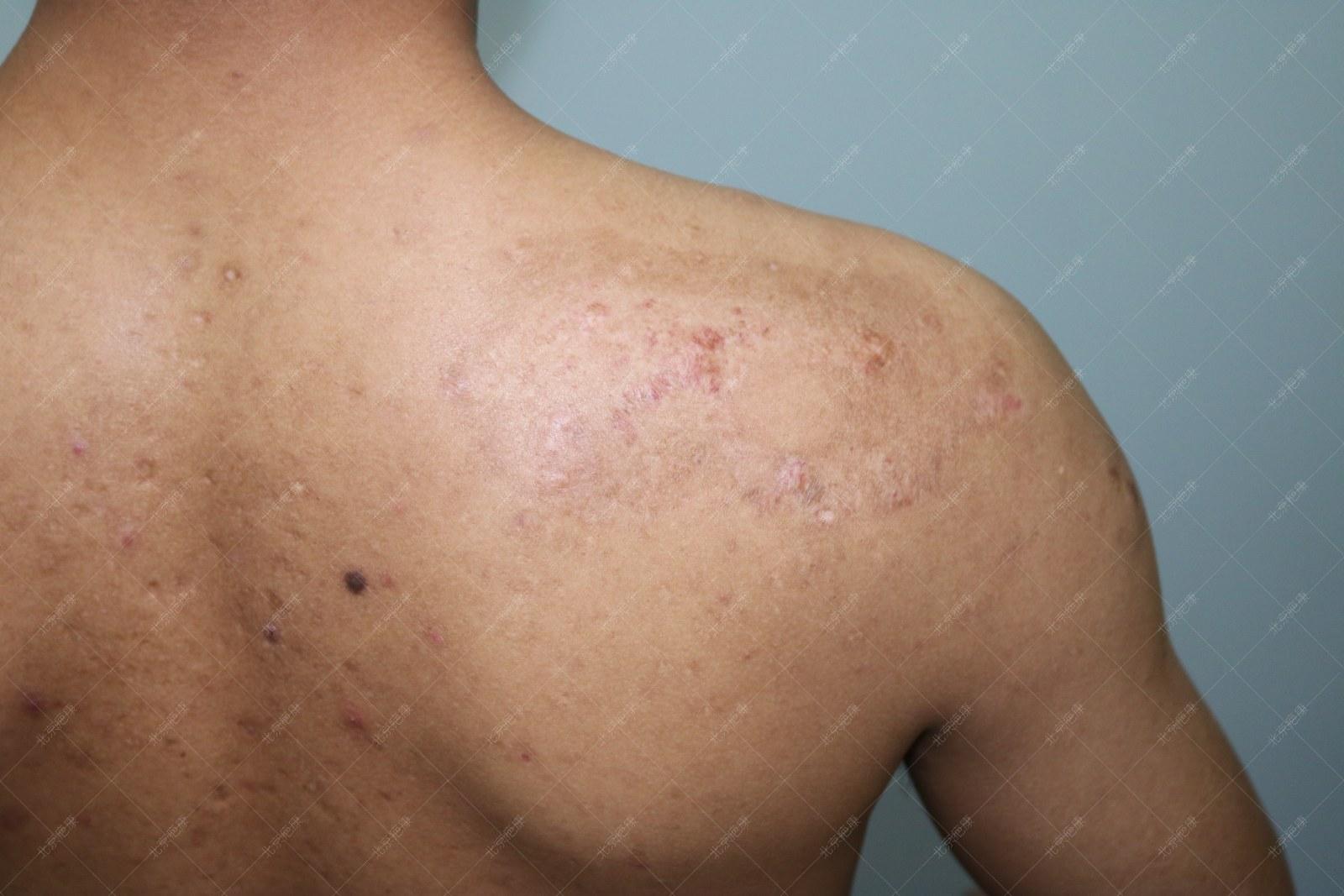 (Scar Kang) Red and swollen bumps on the shoulders - iNEWS