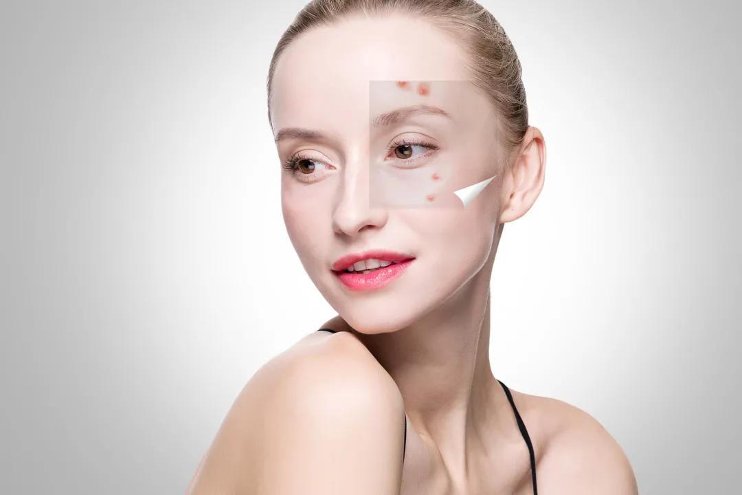 What effect does high GI food have on acne? - iNEWS