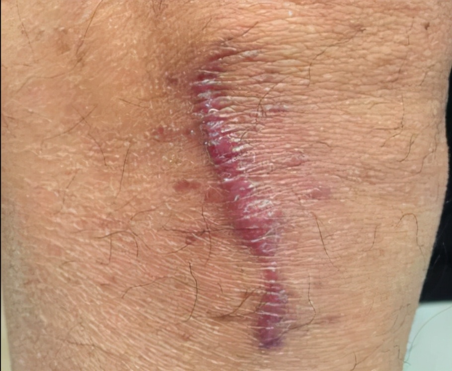 How to repair surgical scar hyperplasia? - iNEWS