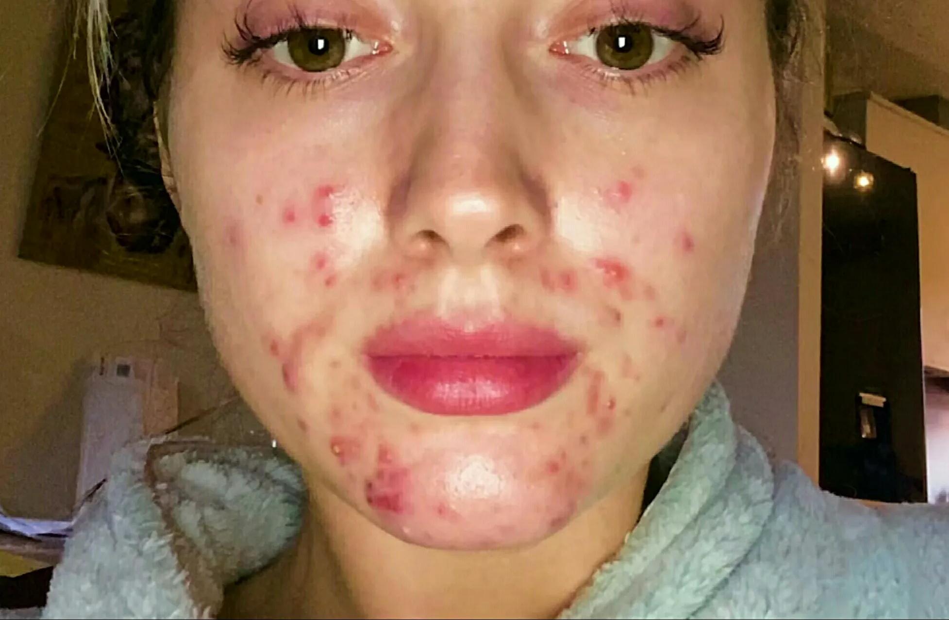 From perfect skin to acne-covered face, this girl's experience makes ...