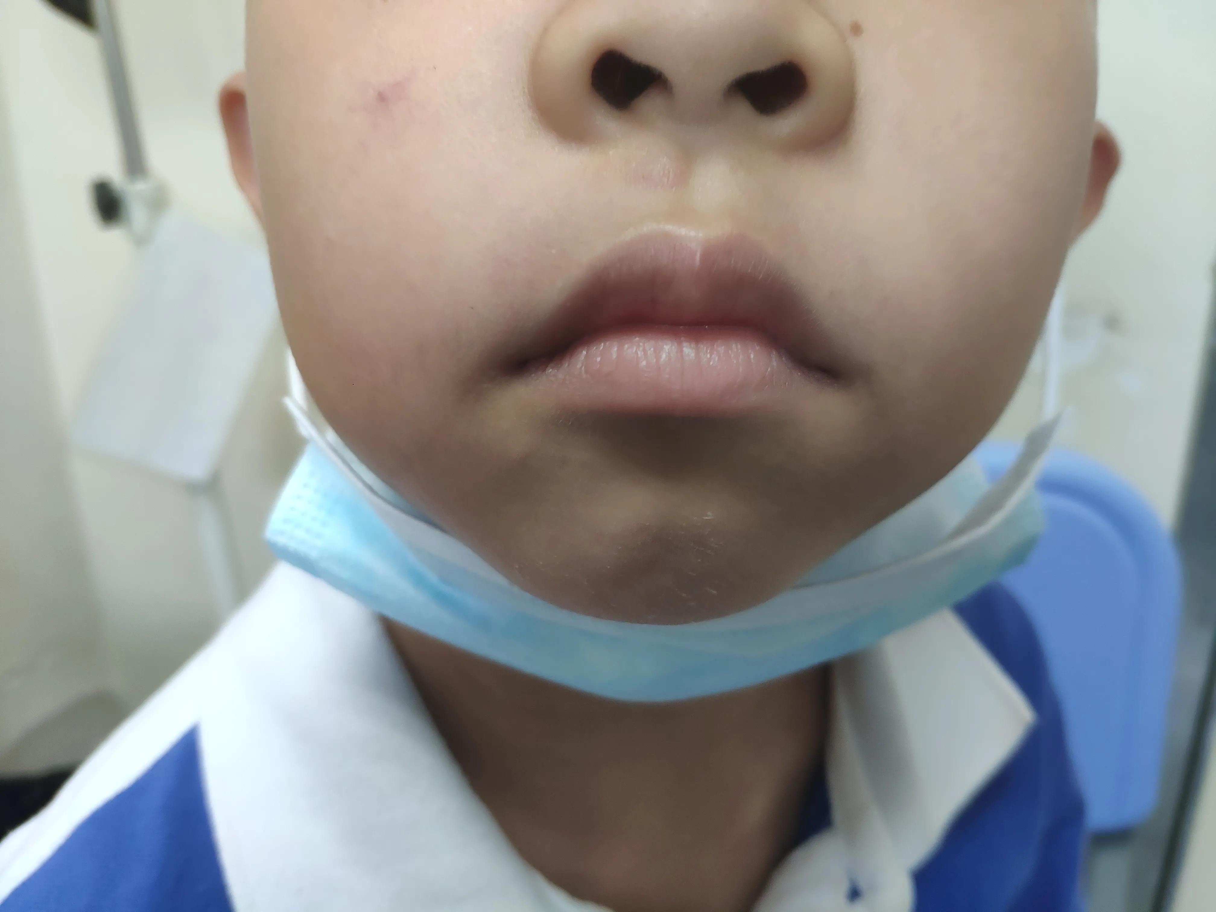 An eight-year-old girl with 70% adenoid hypertrophy, the doctor said ...