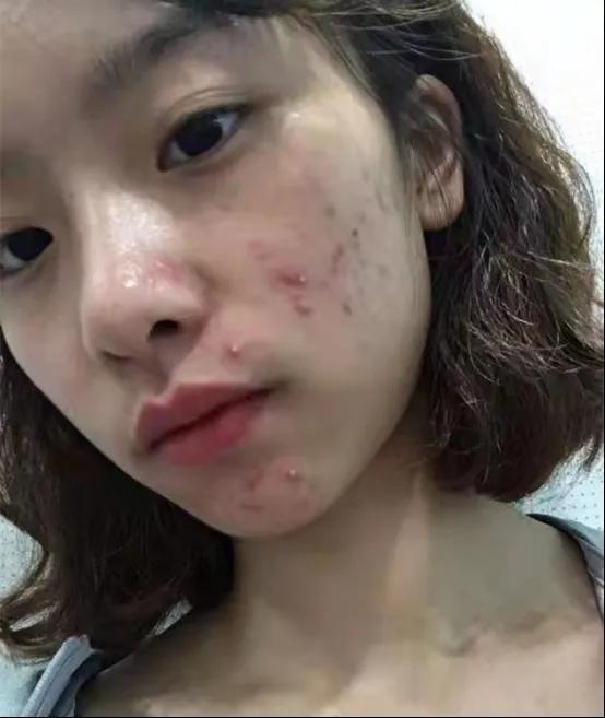 The 22-year-old sophomore girl almost "destroyed her face" in order to ...
