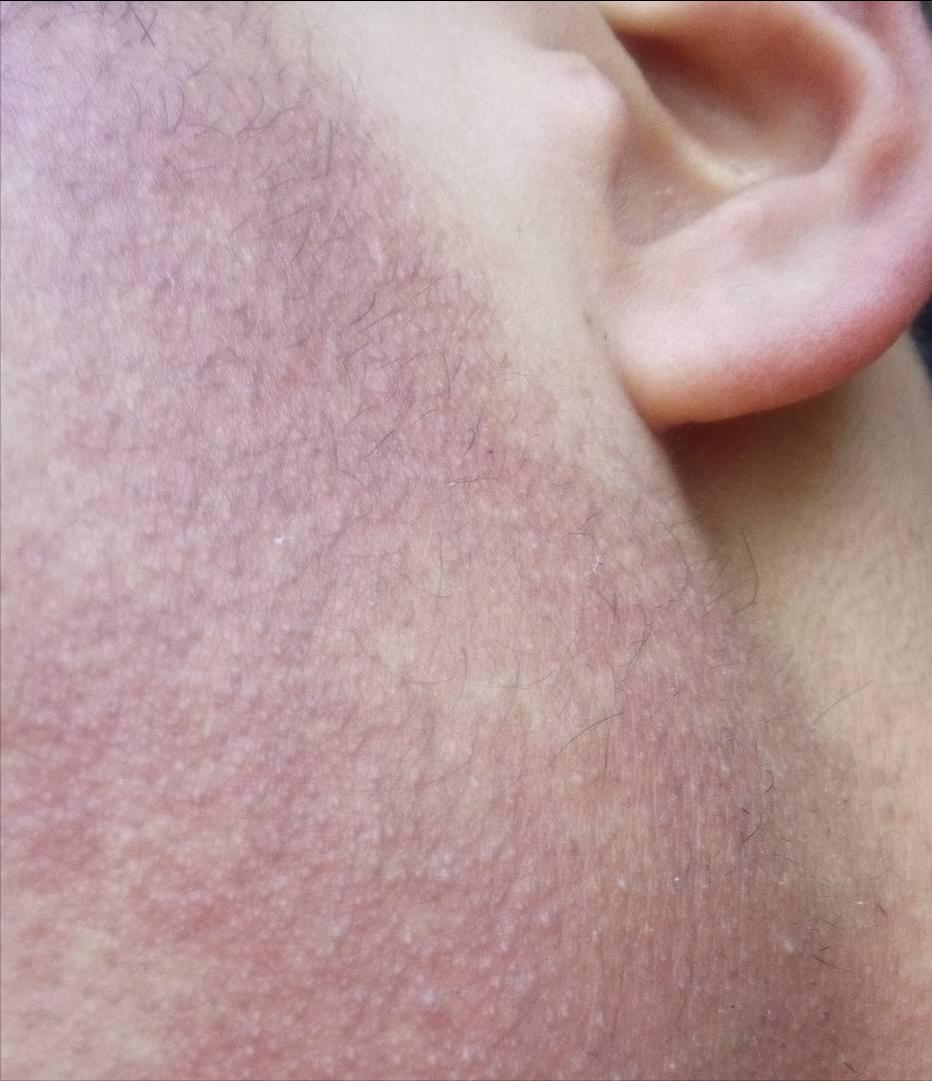 What should I do if I have a lot of goose bumps on my arms and legs?4 ...