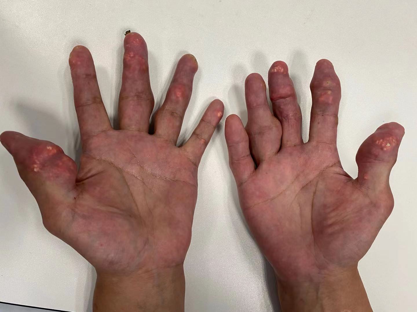 Taking medicine to lower uric acid makes gout more painful. It must be ...