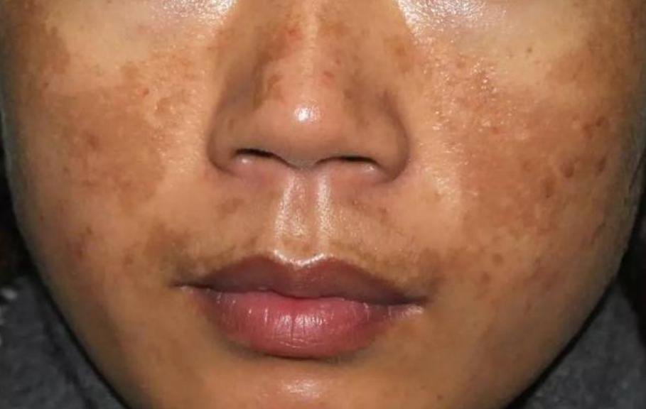 A case of treatment of maladjusted chloasma within 42 years old, 1 ...