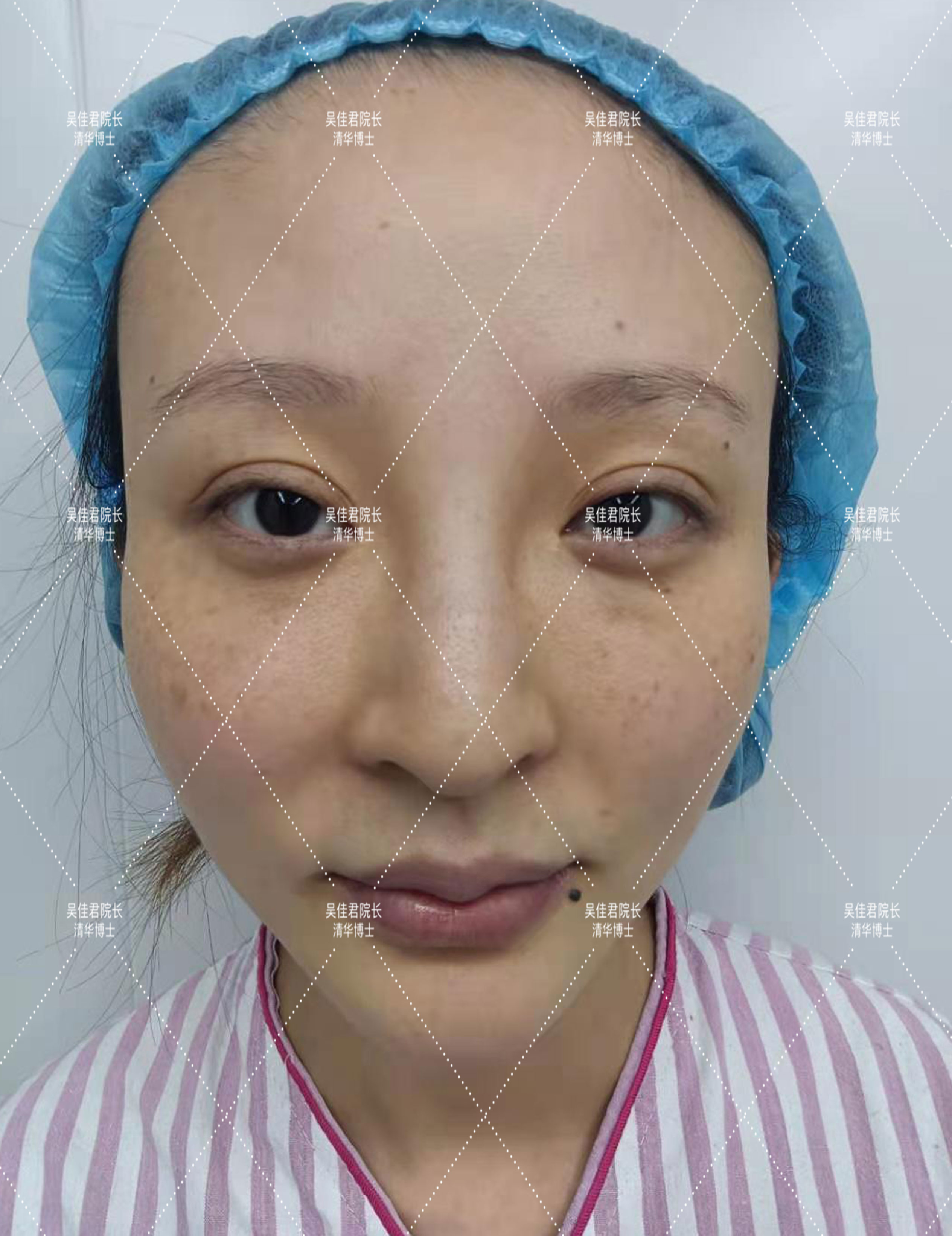 Face collapsed when he was only in his 30s?do not be afraid!Little Lapi ...