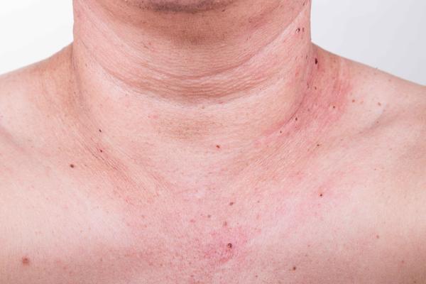 Thick neck is not just obesity, doctor: it may also be related to the ...