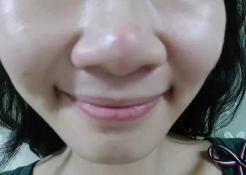 How to improve the garlic nose that expands with the expression - iNEWS