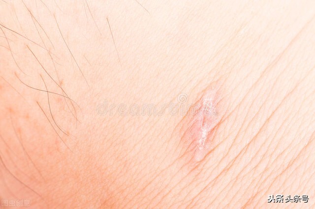 How does the scar constitution form? - iNEWS