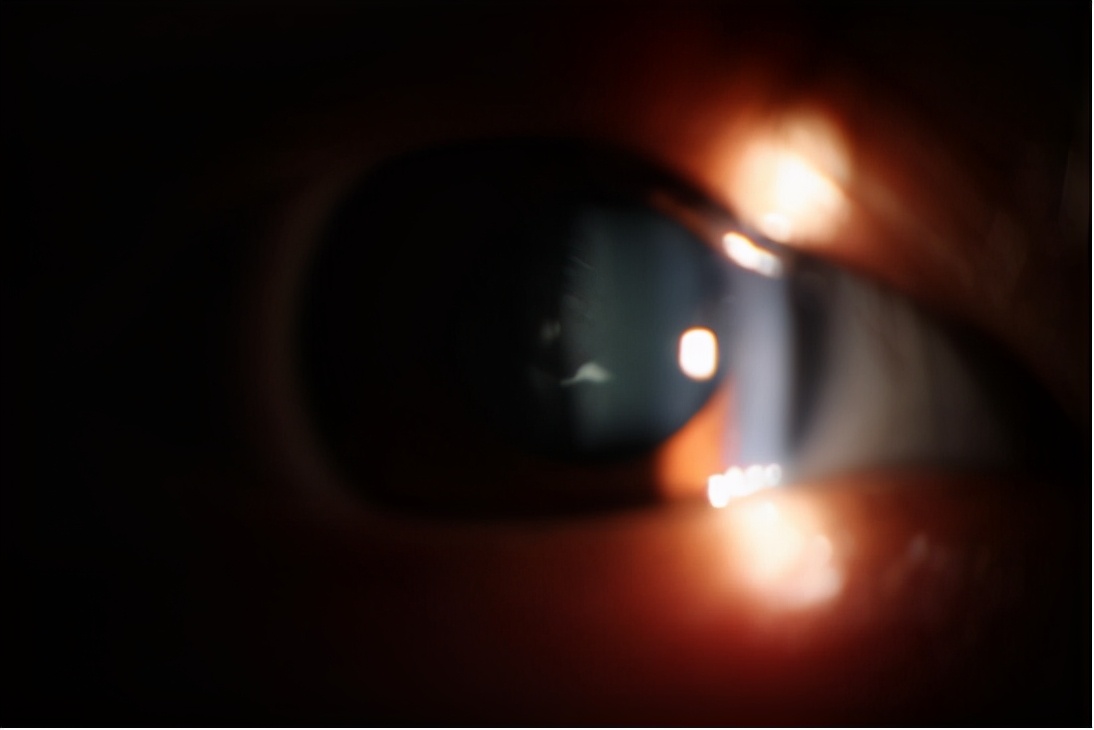 Professor Jolia: Diagnosis and treatment of early-onset high myopia - iNEWS