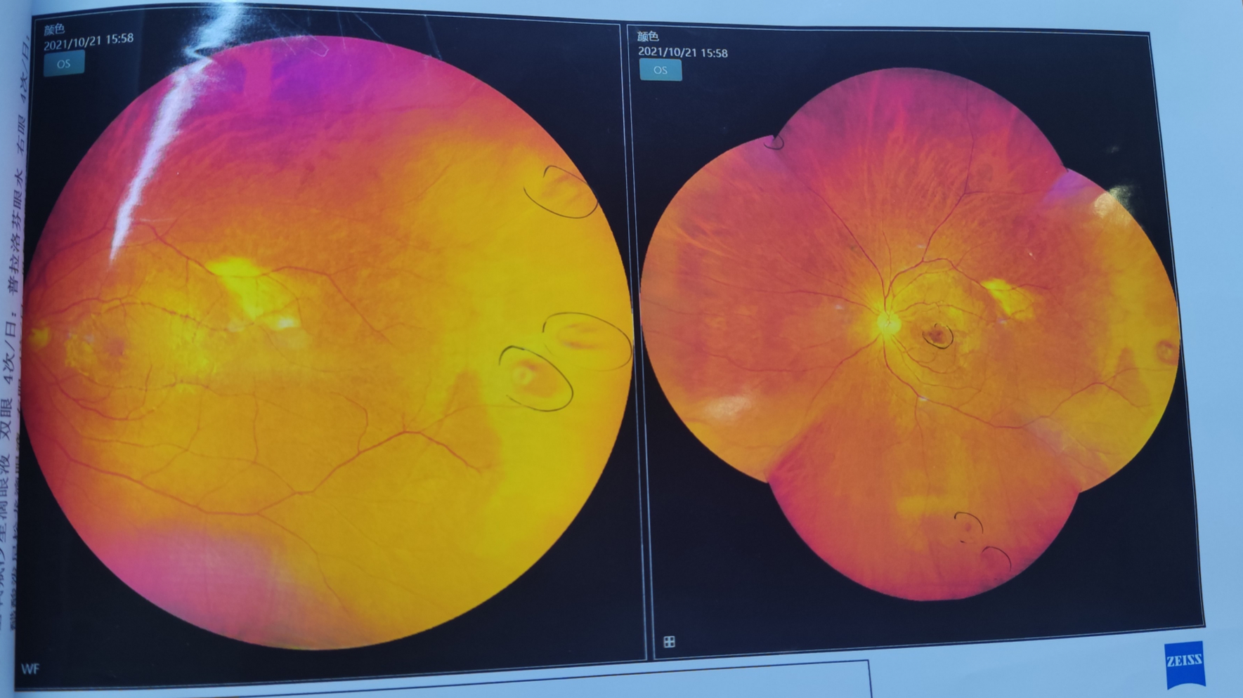 "Fireworks" in the eyes, decreased vision, as everyone knows that it is ...