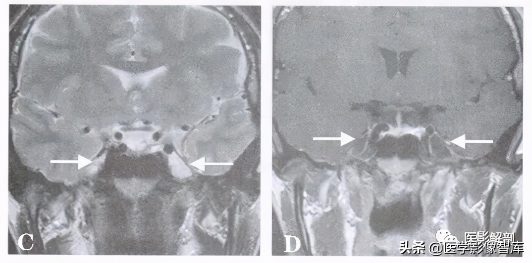 Meckel cavity asymmetry imaging diagnosis - iNEWS