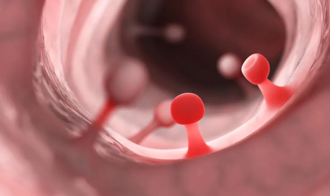 Dangerous polyps have 4 "faces", it's time for colonoscopy beyond this ...