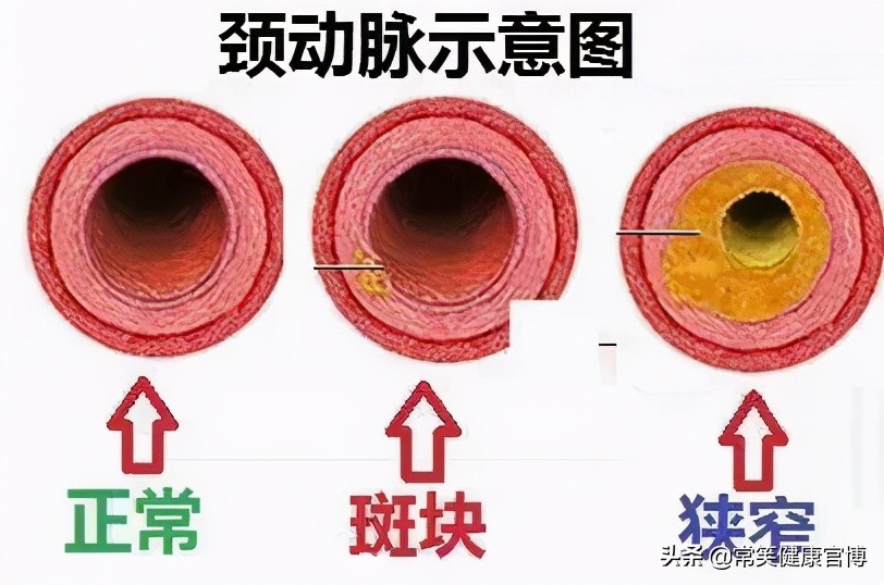 Do you really know stroke?What is the difference between CTA and CT ...