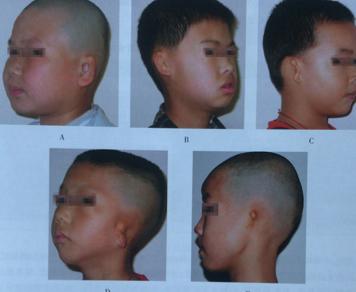 Ear reconstruction surgery: What are the general types of microtia? - iNEWS