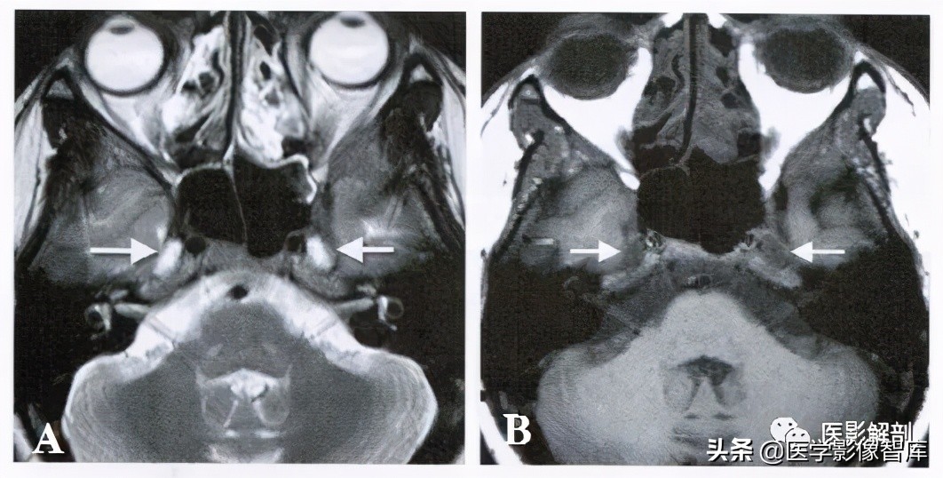 Meckel cavity asymmetry imaging diagnosis - iNEWS
