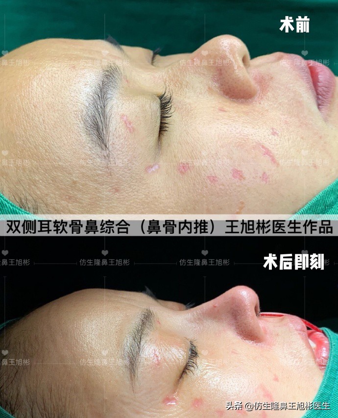 Popular Science: The role of nasal septum extension graft in nasal tip ...