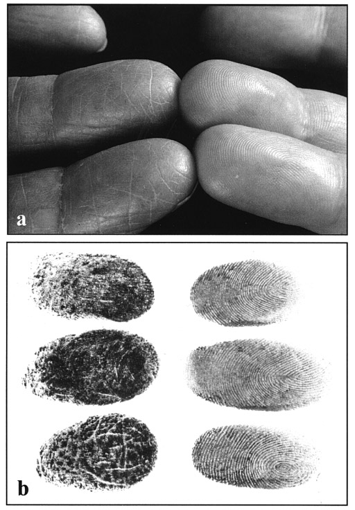 Why do some people have no fingerprints? - iNEWS