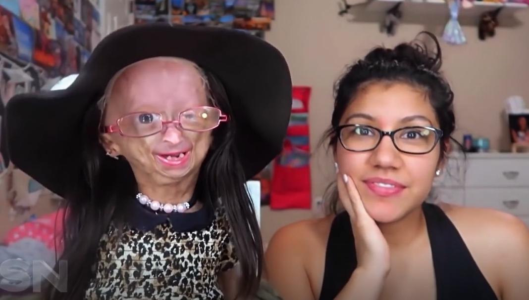The girl suffers from progeria, looks like an alien, but is a big star ...