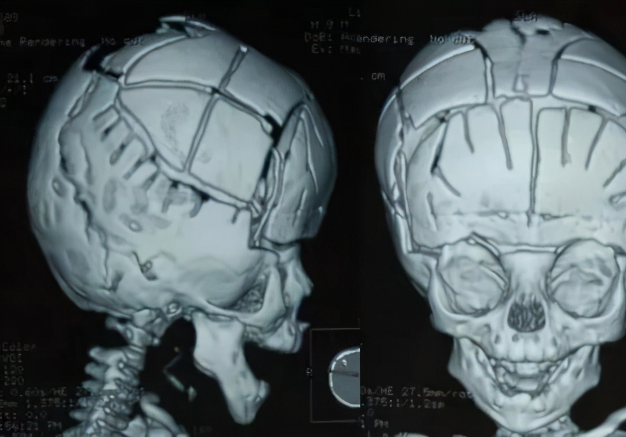 Is the small head of a child a disease?What is the difference between ...