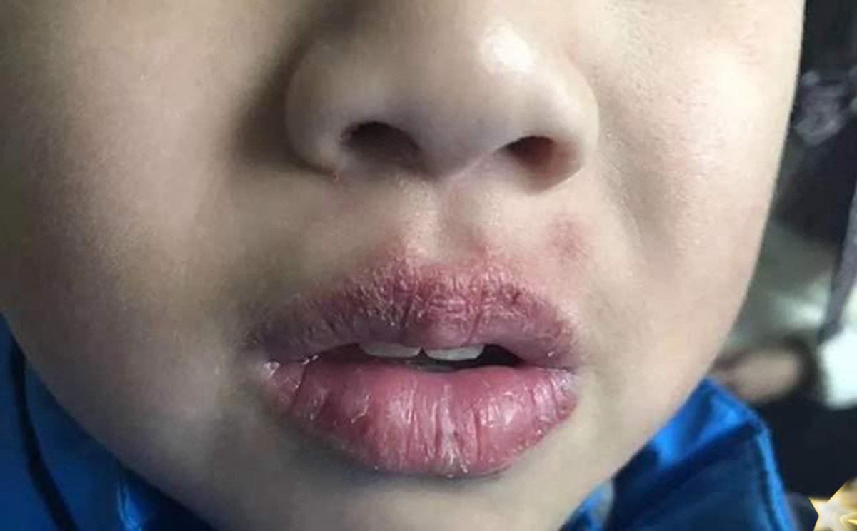 What should I do if my child has chapped lips, peeling and bleeding?The doctor teaches you ...