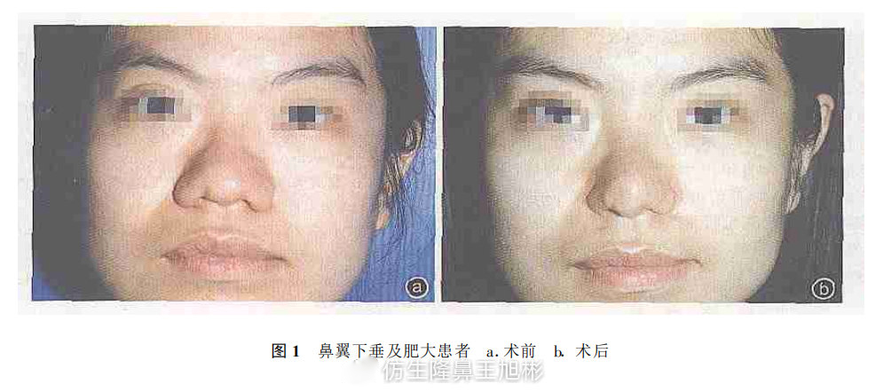 Nose alar hypertrophy/sagging correction, will there be scars in the ...