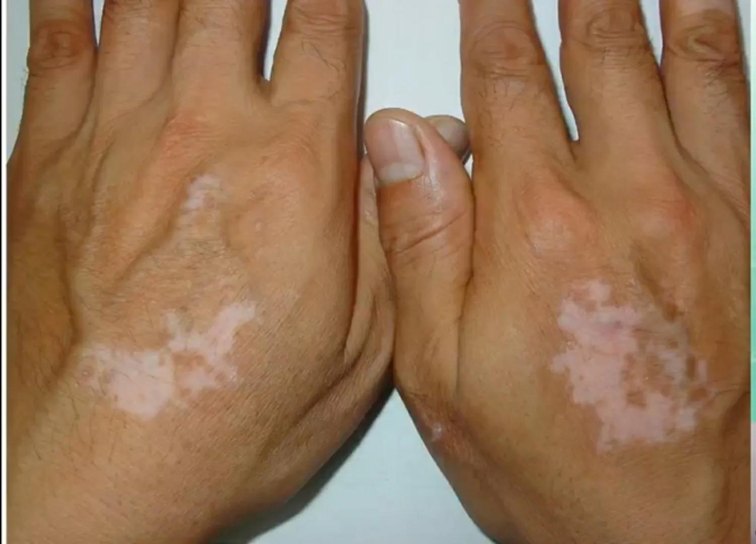 Topical treatment of vitiligo - iNEWS
