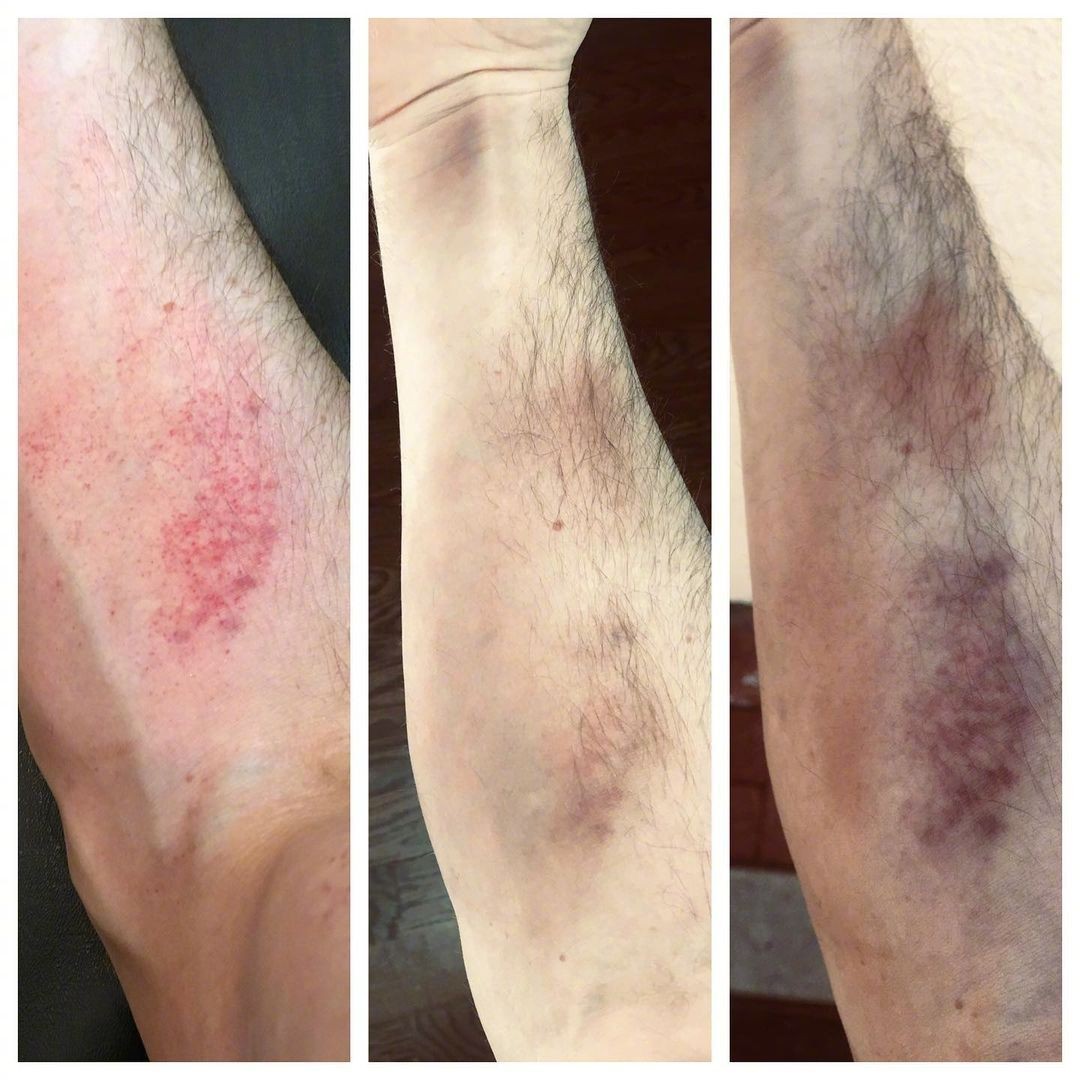 Captain America's new movie has an arm injury and describes the bruise ...