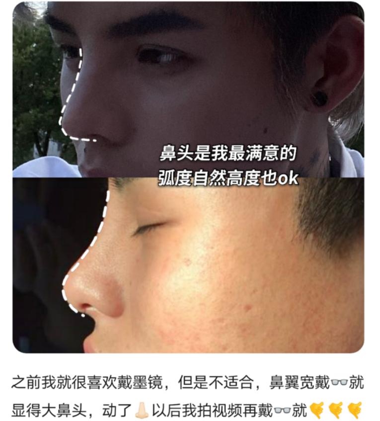 Yin Shihang showed his plastic surgery process generously. After seeing ...