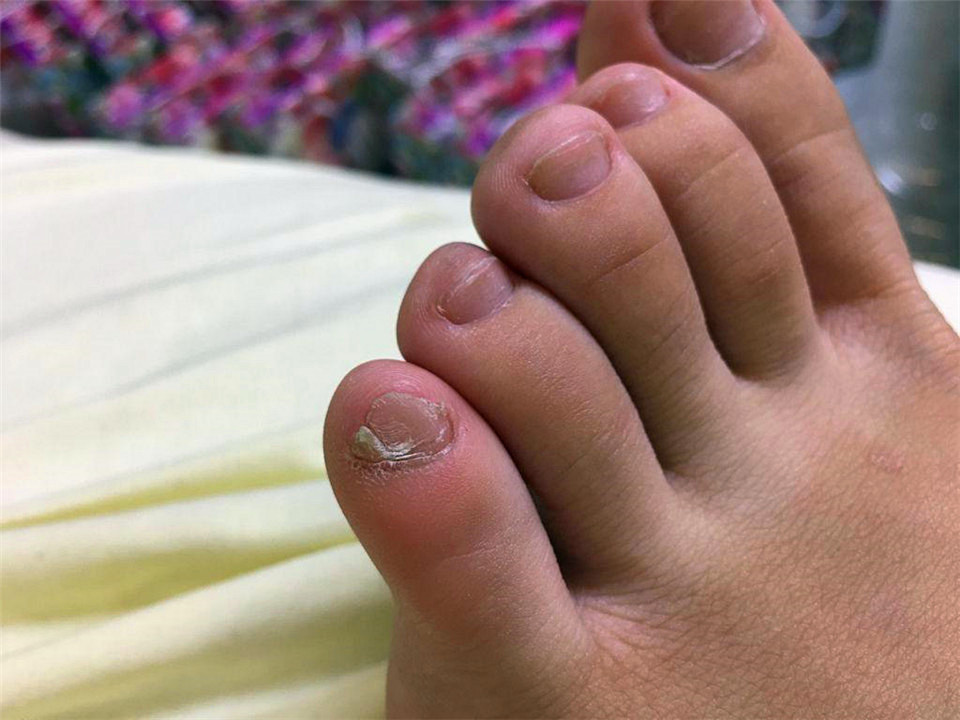 What is the origin of people who split their little toenails in two?Are ...