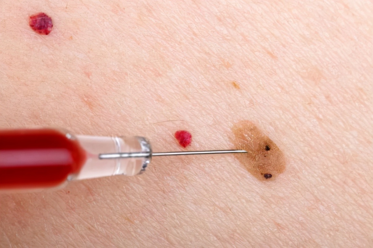 Is a "vascular mole" on the skin cancerous?Reminder: learn to ...